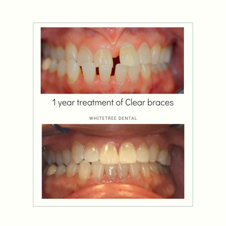 Invisalign - White Tree Dental